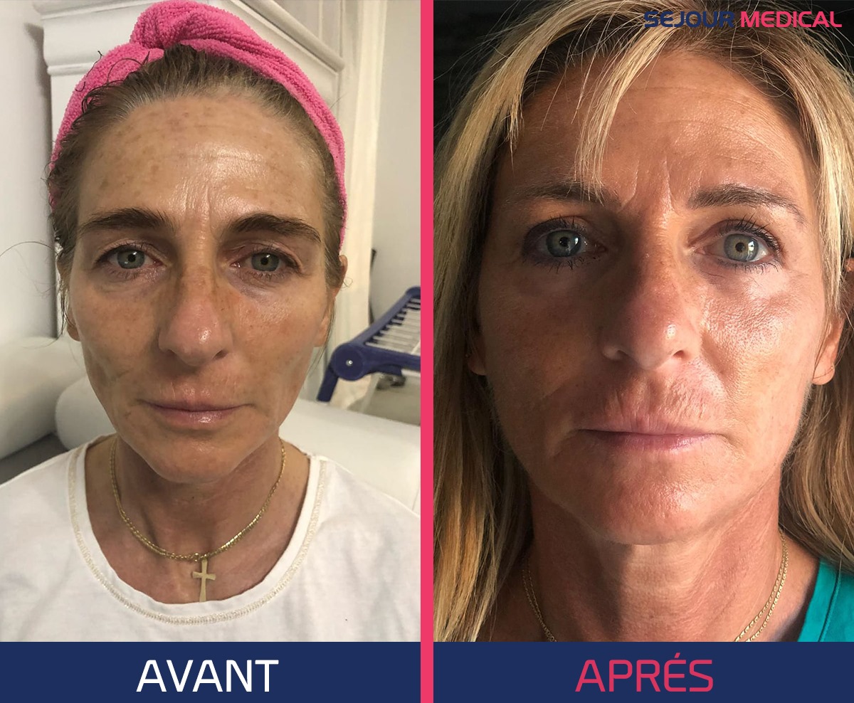 Blépharoplastie Tunisie, chirurgie des paupières en Tunisie